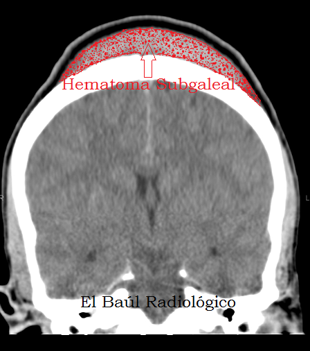 El Baúl Radiológico: 2) HEMATOMA SUBGALEAL: HALLAZGOS EN TOMOGRAFÍA ...
