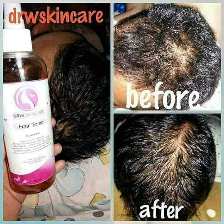 Testimoni Hair tonic Drw Skincare - Agen DRW Skincare