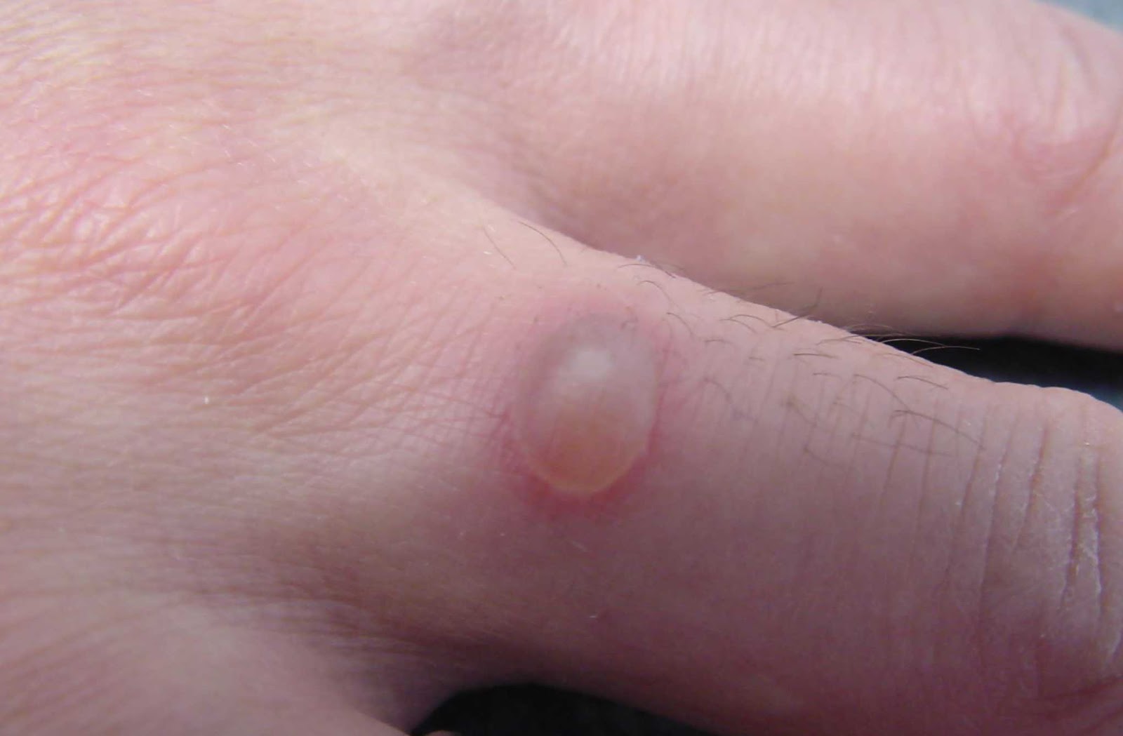 Rugas e Verrugas: Tatamento de verrugas vulgares