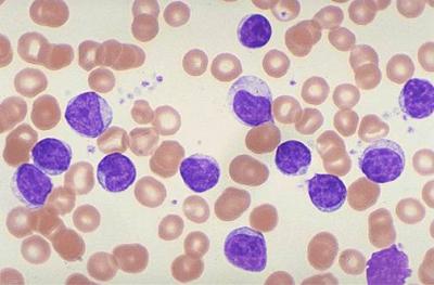 Cancer, A Lab Tech 's Perspective: Chronic Lymphocytic Leukemia