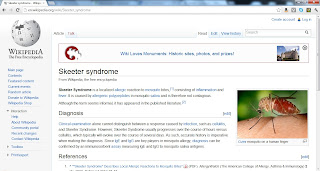 Skeeter Syndrome: Mystery Diagnosis