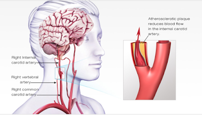 10 Signs That Indicate An Impending Stroke And Natural Solutions For ...