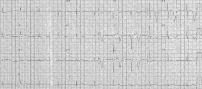 ECG of the Week: ECG of the Week - 28th January 2013 - Interpretation