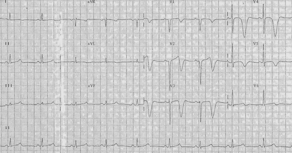 Ecg Of The Week Ecg Of The Week 28th January 2013 Interpretation
