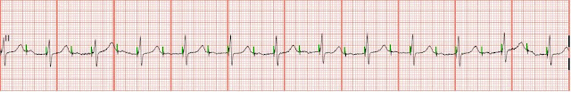EKG Rhythm Strip Quiz 56: Paced Rhythms