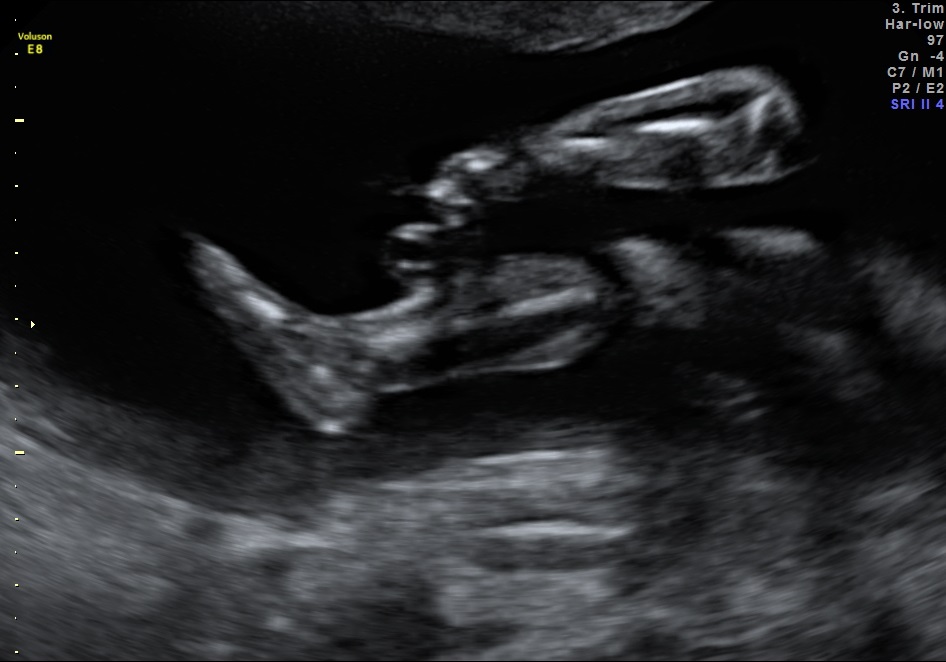 What is trisomy 18? | Rumer's Rainbow