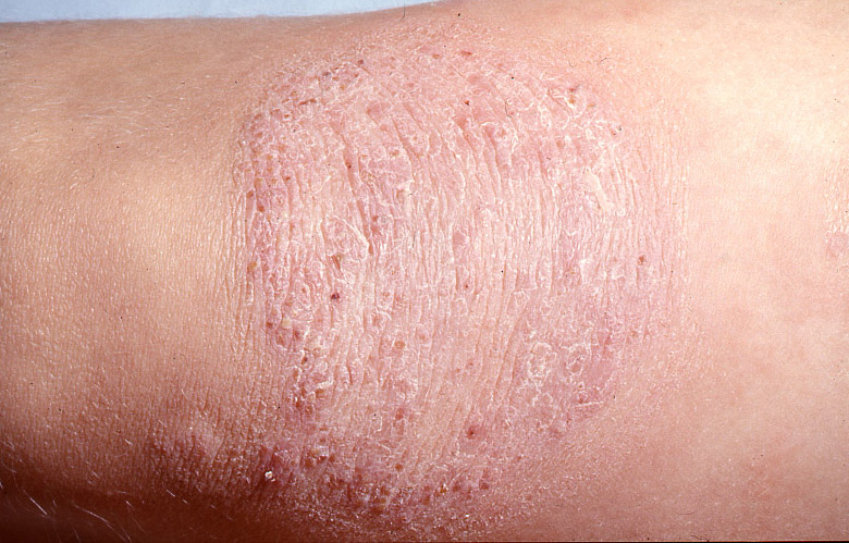 KING HSAN IV: Know your Symptoms!