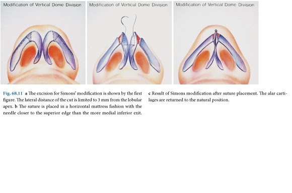Nose Revision Surgery and Surgeons: Refining the nasal tip with Newer ...