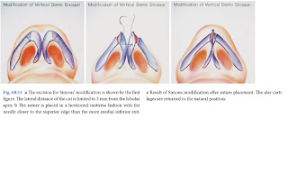 Shield Graft: Refining the nasal tip with Newer VDD techniques.