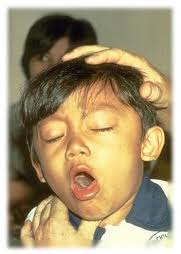 Perkembangan Penyakit Di Indonesia: Batuk rejan = Tergolong Penyakit ...