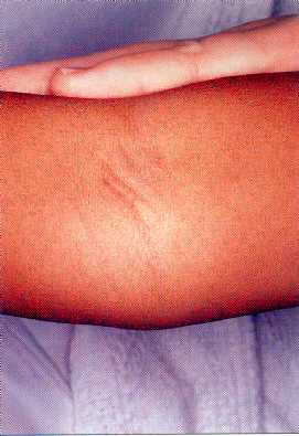 Cuando la amigdalitis viene acompañada. La escarlatina | Con P de Pediatría