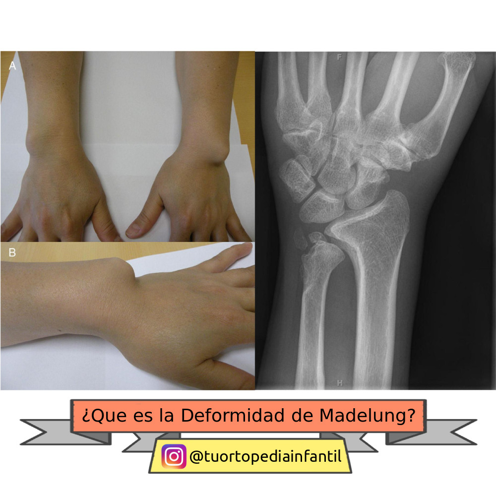 ¿Que es la Deformidad de Madelung?