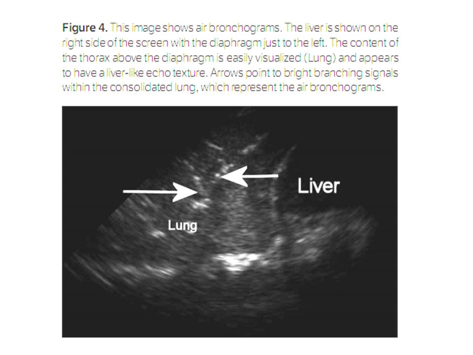 BÀI SOẠN VỀ SIÊU ÂM CHẨN ĐOÁN: Lung Ultrasound in Evaluation of Pneumonia