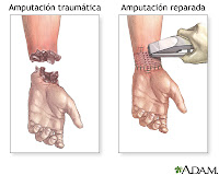 ENFERMERÍA QUIRÚRGICA: “AMPUTACIONES.”
