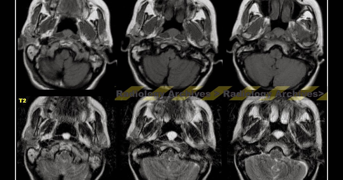 Radiology Archives: Κύστη Thornwaldt*