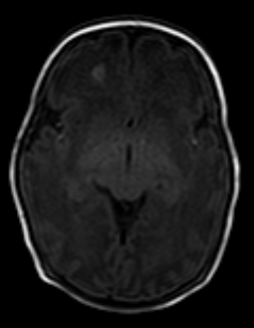 Periventricular leukomalacia -MRI - Sumer's Radiology Blog