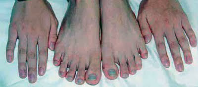 Differential cyanosis