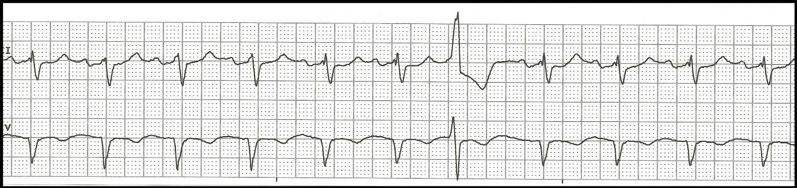 Practice ECG Rhythm Strips 100