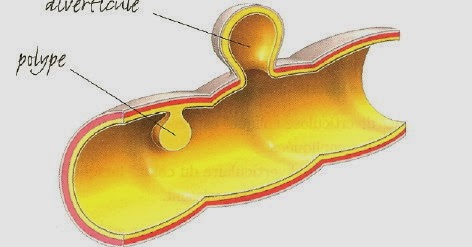 Diverticulose et sigmoïdite diverticulaire | Récap' IDE