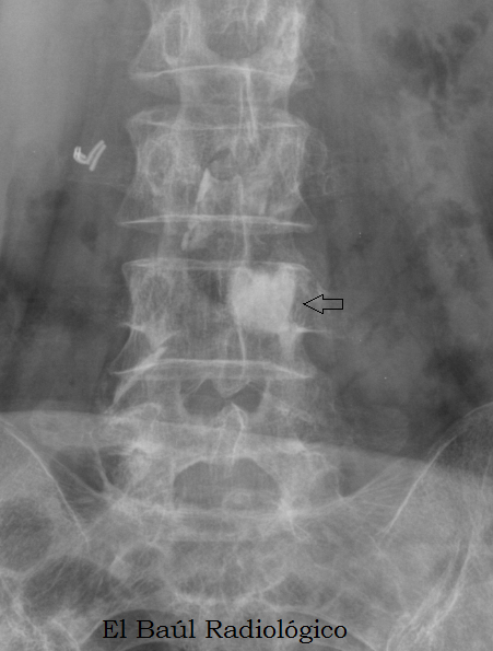 El Baúl Radiológico: ENOSTOSIS: ISLOTE ÓSEO (Bone Island: CT and MRI ...