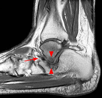 MRI Musculo-Skeletal Section: Lateral hindfoot impingement.