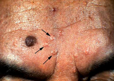 Dermatocare: Worried about spots on your face?