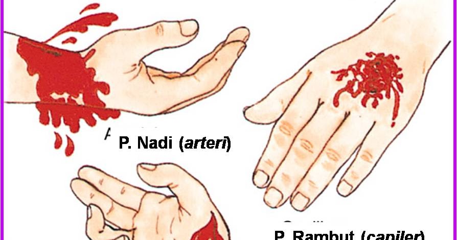 PENOLONG PERTAMA INDONESIA: 4 CARA/ TEKNIK PENANGANAN PERDARAHAN DAN ...