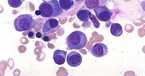 Desvendando o mieloma múltiplo: um câncer raro que merece atenção