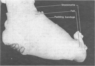 傷口大師: Off-loading 減壓-Scotchcast boot樹脂石膏鞋