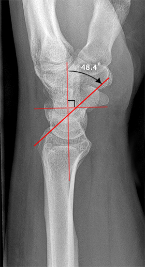 Scaphoid X Ray Angle