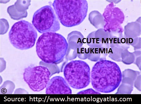 Lab Atlas: Acute Myeloid Leukemia