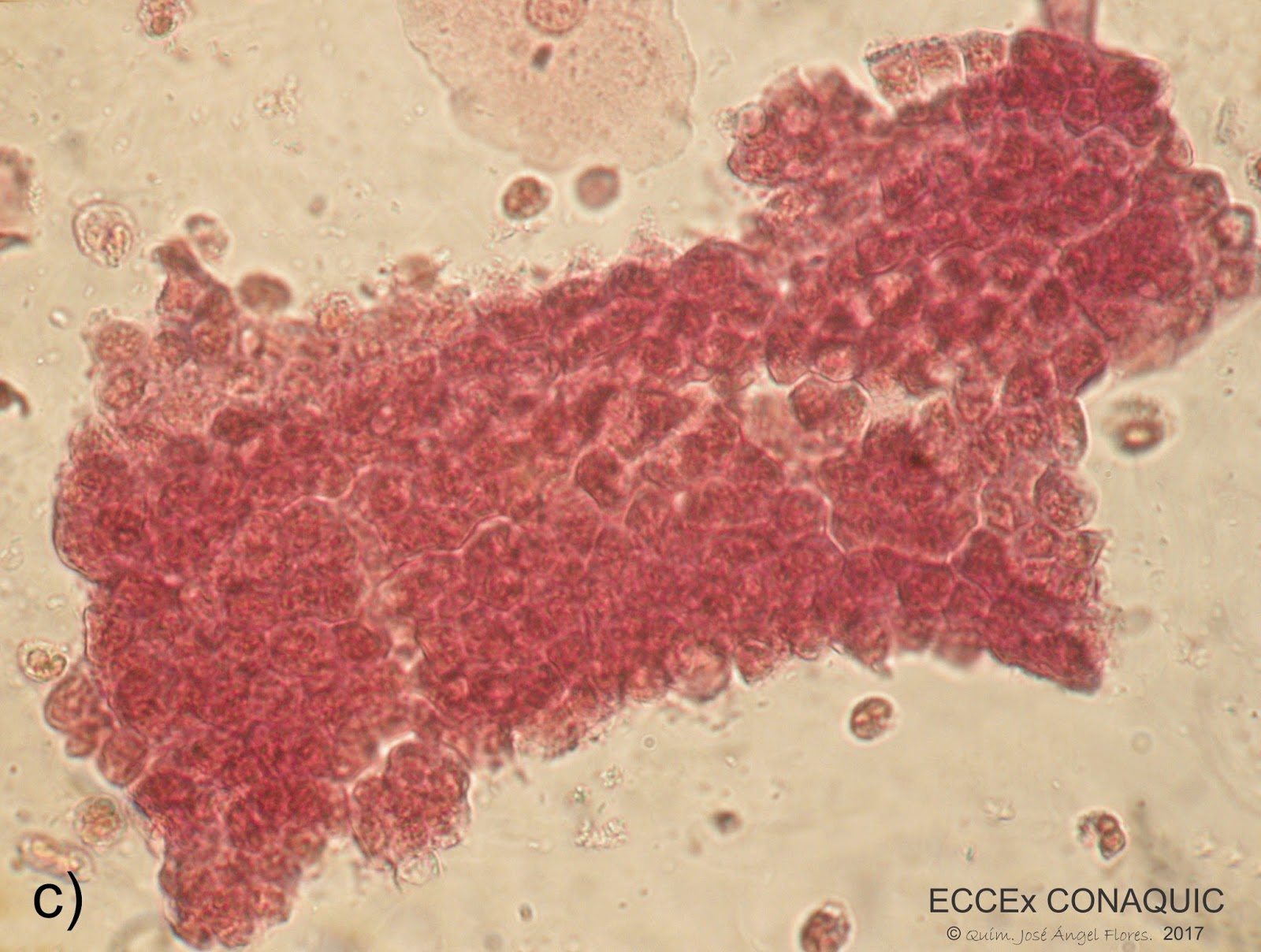 Caso UR-abril-17 (Enfoque: Epitelio)