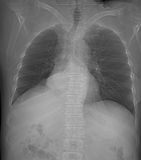 Resident's Miss RLL Collapse-Exam Case - Sumer's Radiology Blog