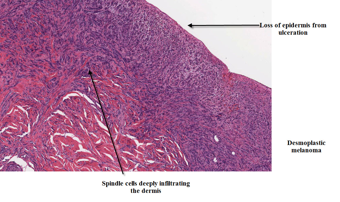 Dermpath Made Simple - Neoplastic: Desmoplastic Melanoma