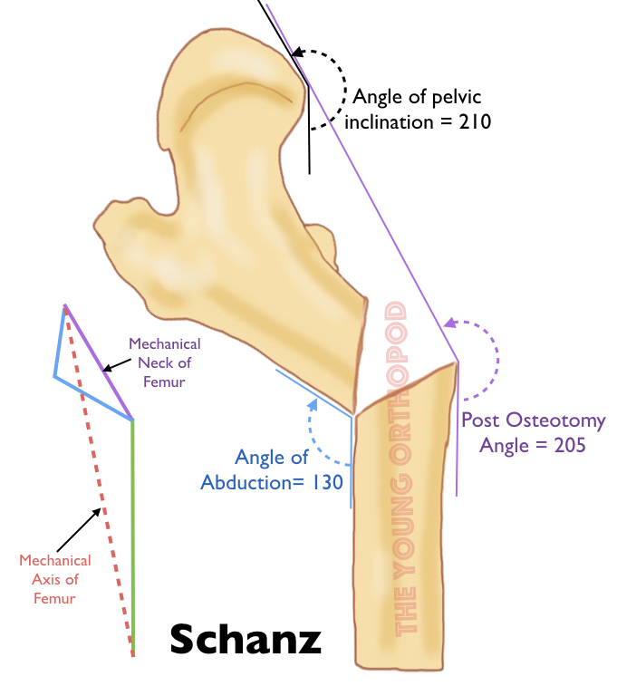Pelvic Support Osteotomy