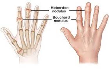 Sterker dan pijn: Van puntjes naar bobbels (handen)