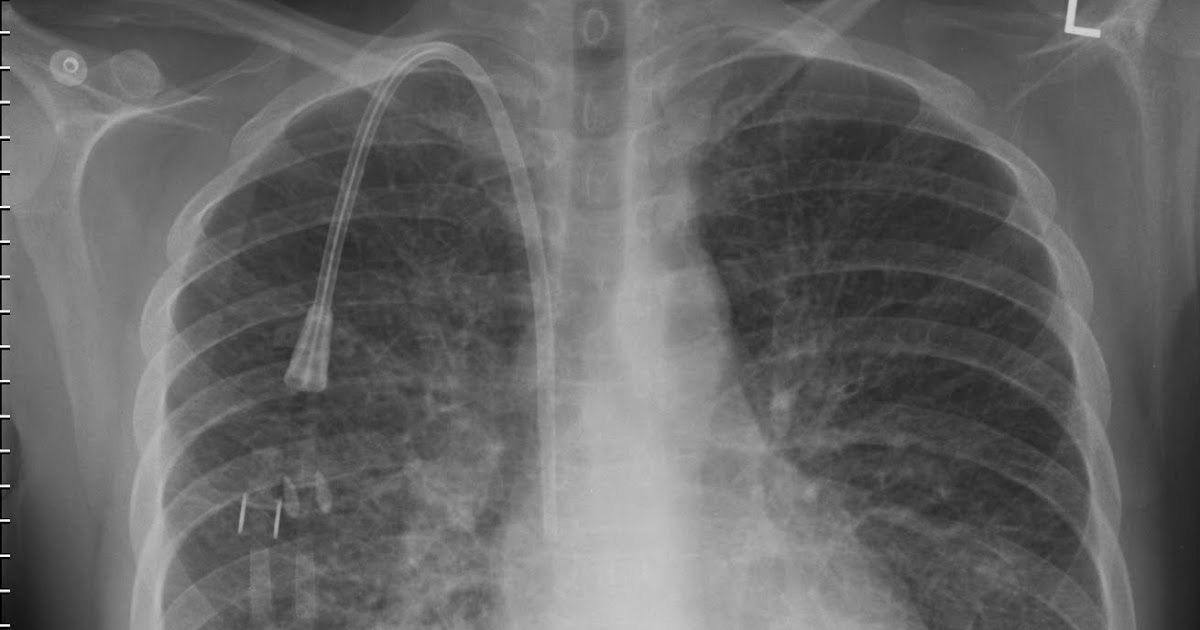Post Gad: Pulmonary Edema & Kerley B lines