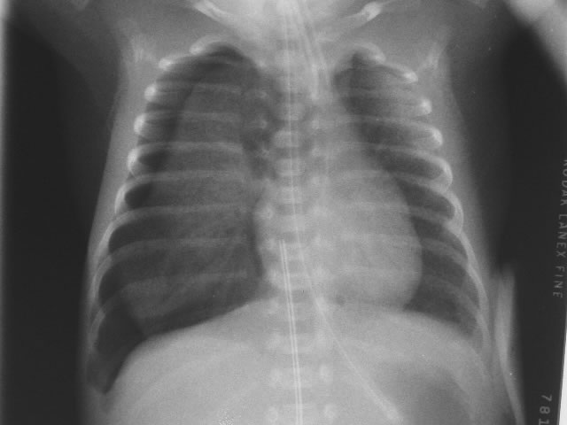 BEDAH UMUM FKUI: Pneumotoraks spontan pada neonatus