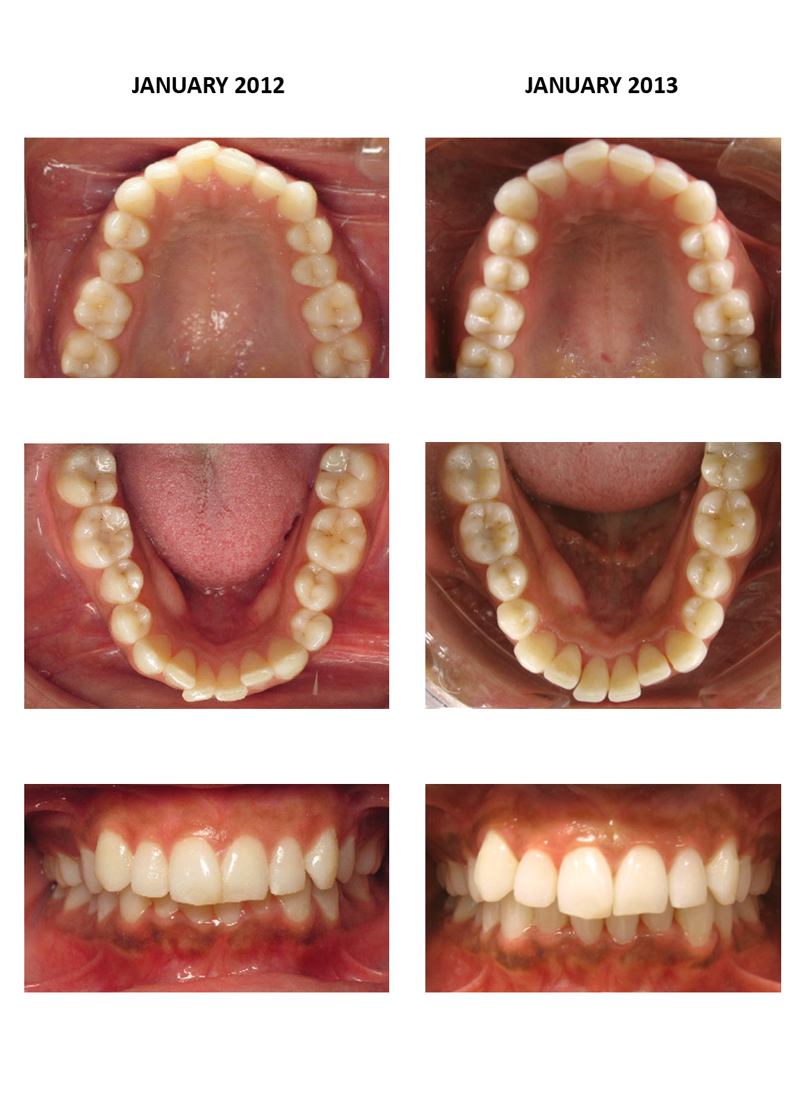 Toronto Invisalign - Brand New Smile :): Officially One Year With My ...