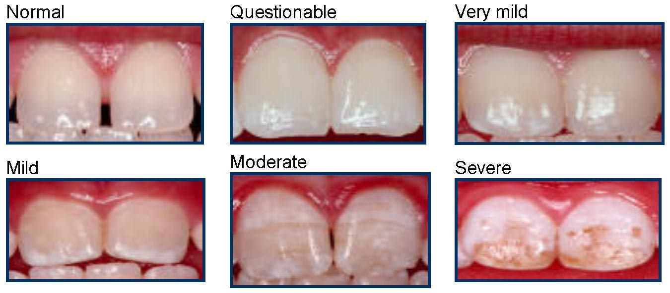 Dentistry And Medicine Dental Fluorosis Dentistry And Medicine Dental Fluorosis
