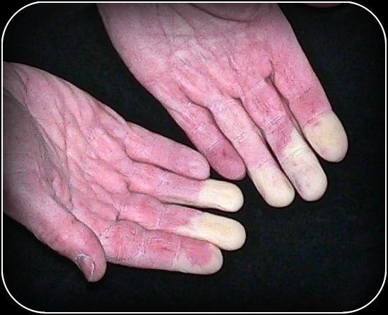 Vibration White Finger Claims