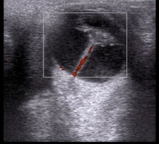 Persistent Hyperplastic Primary Vitreous : Case Report - Sumer's ...