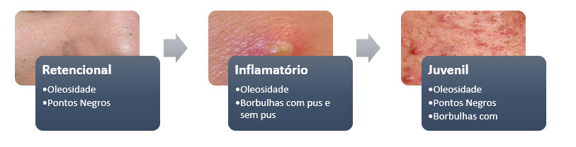 O que é a Acne? Uma doença ou um problema estético? Part 1 | Cantinho ...