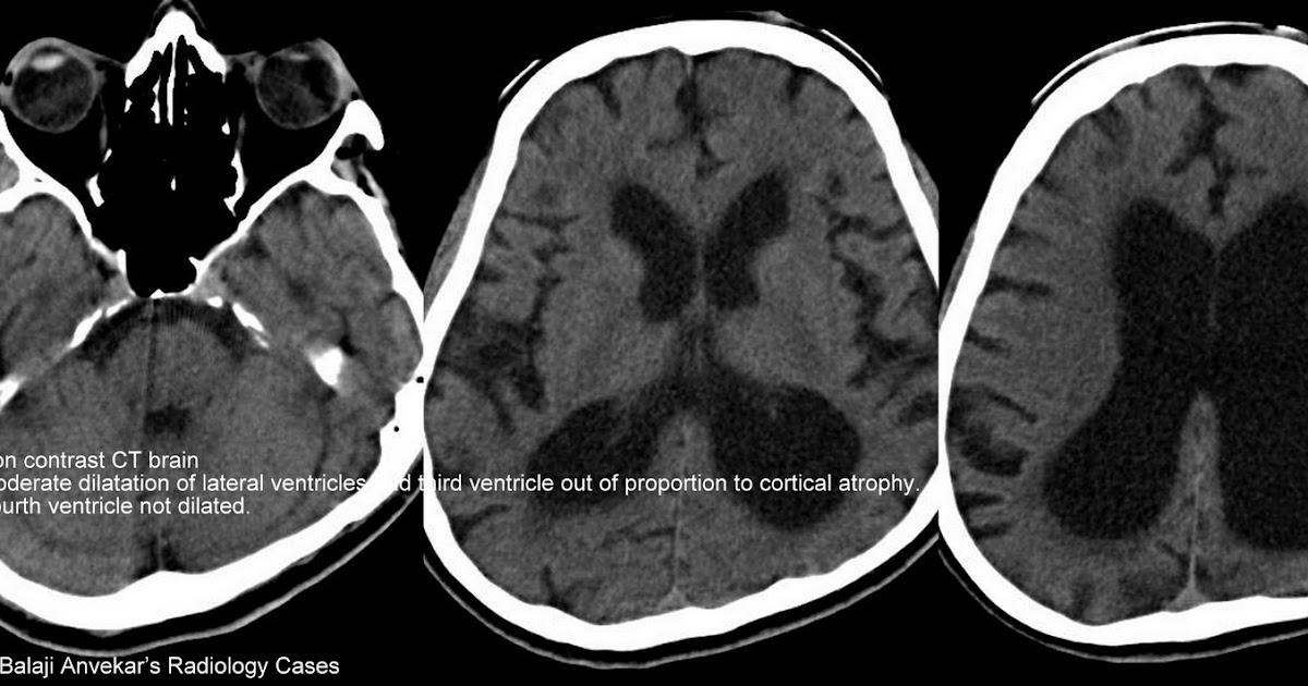 Neuroradiology Cases: Normal Pressure Hydrocephalus Imaging Findings