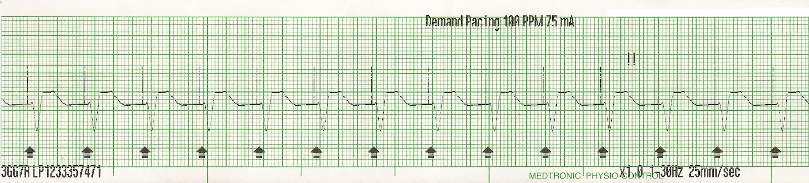 Float Nurse: PALS Megacode: Unstable Pediatric Bradycardia Part 4