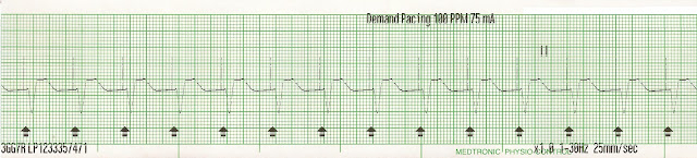 PALS Megacode: Unstable Pediatric Bradycardia Part 5