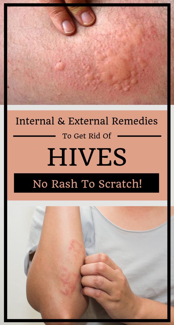How To Get Rid Of Skin Rashes how-to-get-rid-of-skin-rashes