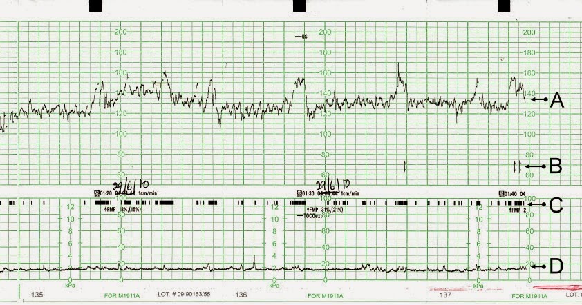 CARDIOTOCOGRAPHY PAPER (CTG PAPER)
