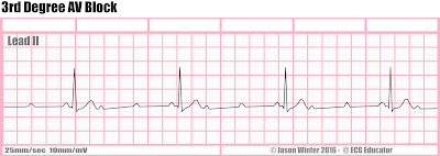 ECG Educator Blog : Six Second ECG Rhythm Strips