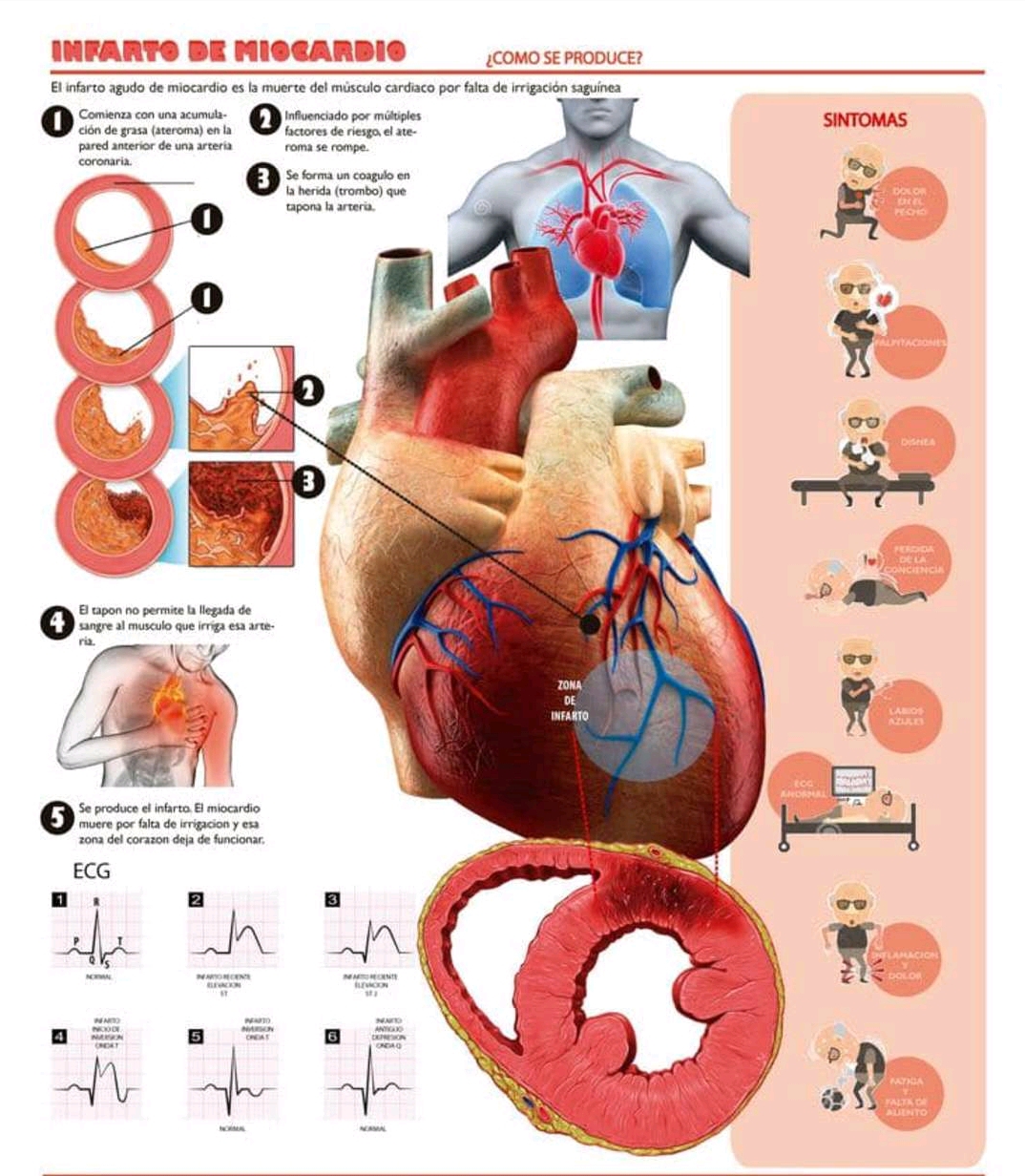 INFARTO DE MIOCARDIO